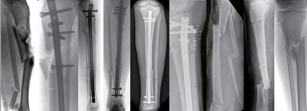 Meta Semi Extended - Mediplat